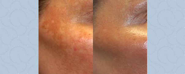 Melasma Treatment in Greater Houston, TX | DermSurgery Associates